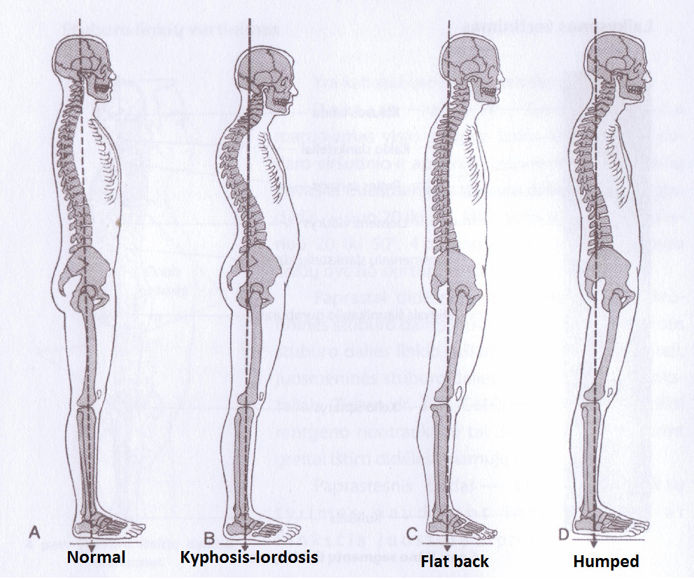 Quando la lordosi diventa una patologia e come tale va trattata