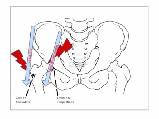 L’anca a scatto: le diverse tipologie, la diagnosi e i trattamenti