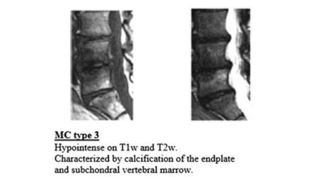 Degenerazione del disco intervertebrale, infezioni e asse intestino ...
